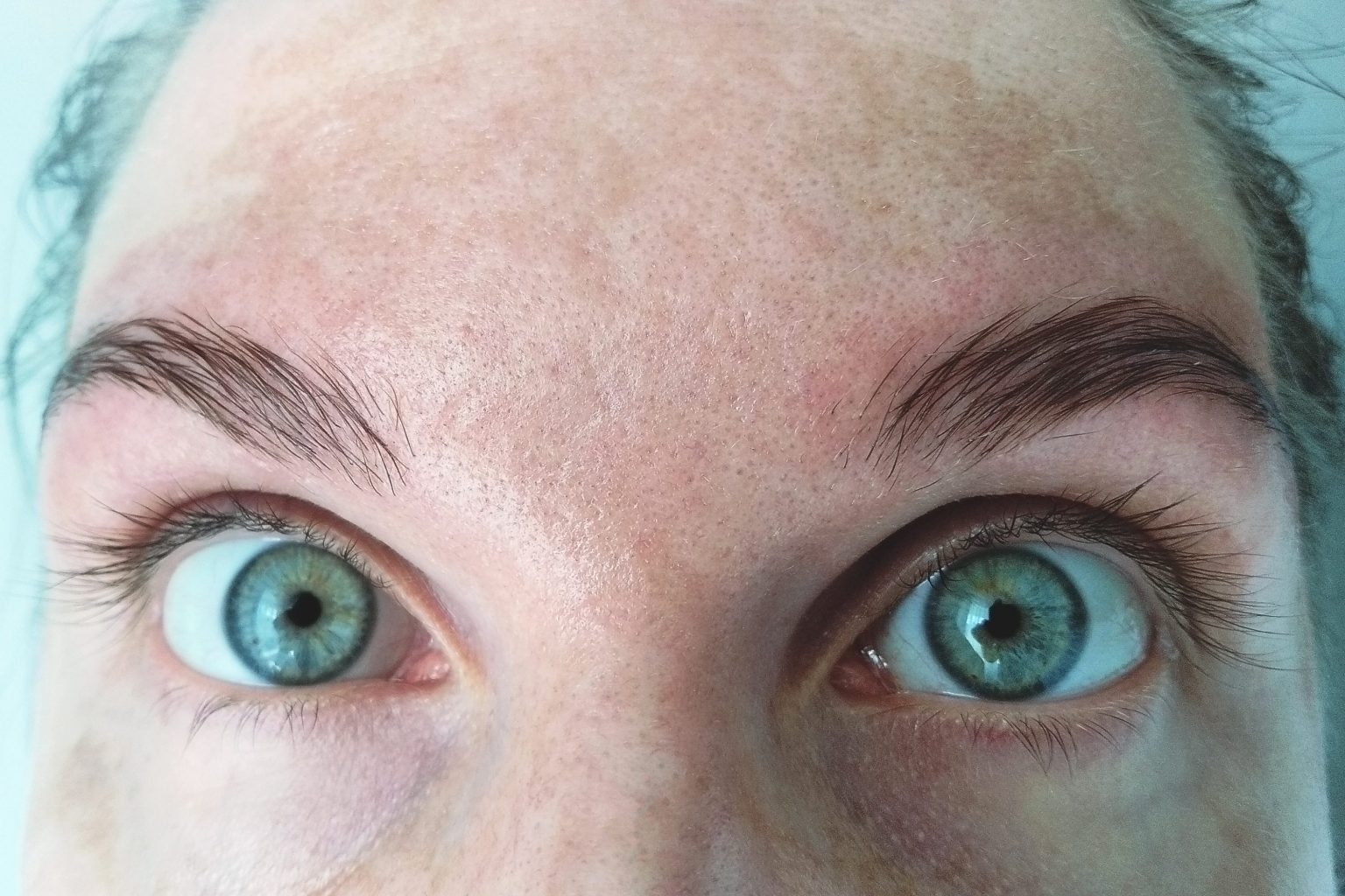 Macchie bianche: rimedi naturali | Ohga!